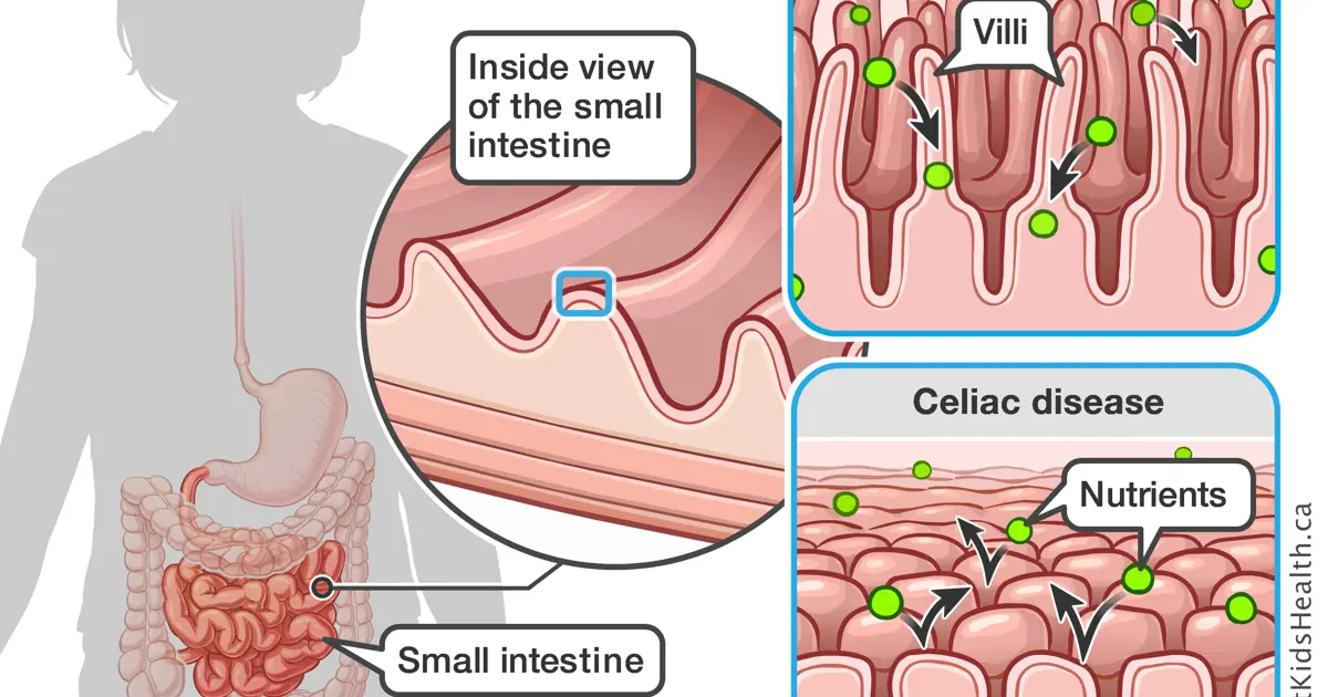 Celiac disease